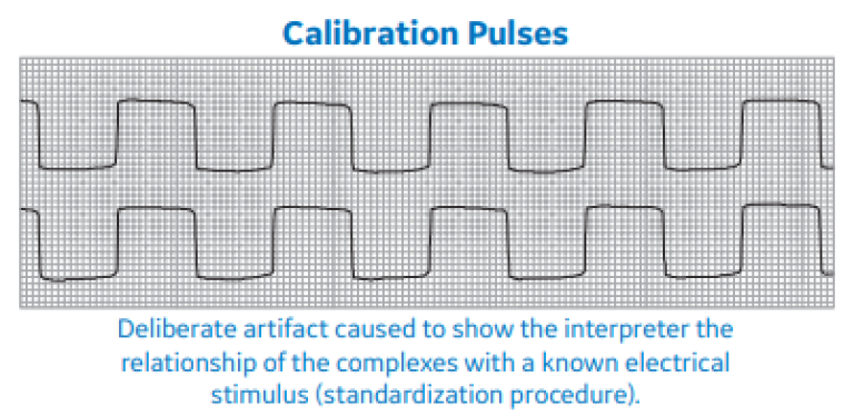 Arrhythmia Recognition Part 2 Clinical View